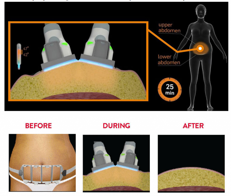 V18 1060nm Diode Laser for Body Slimming, Body Contouring, Body Shaping ...