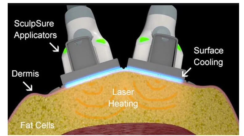 V18 1060nm Diode Laser for Body Slimming, Body Contouring, Body Shaping ...